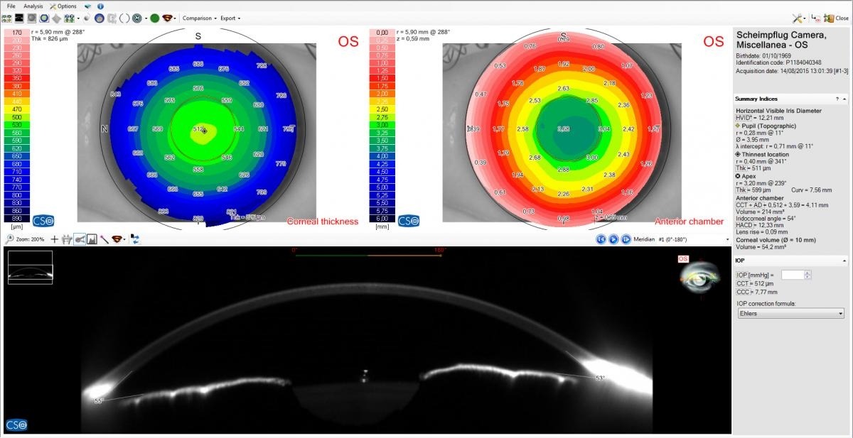SIRIUS+ Hornhaut-Topographie und -Tomographiesystem