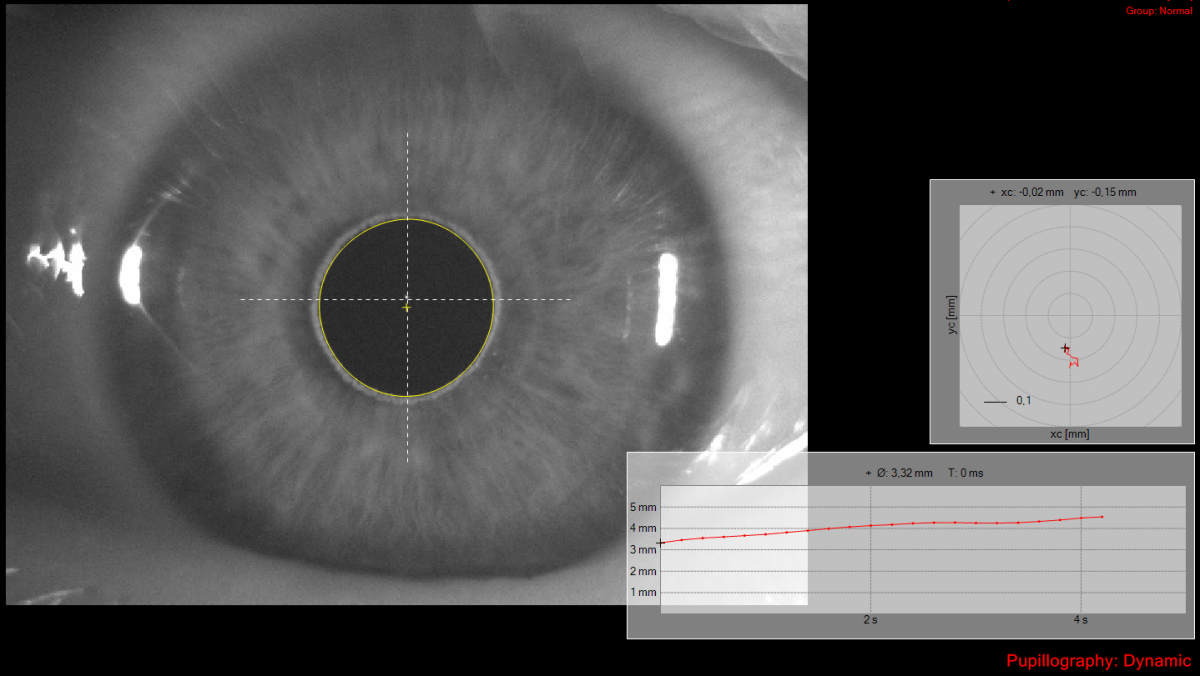 SIRIUS+ Hornhaut-Topographie und -Tomographiesystem